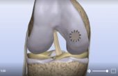 Cartilage Transplantation Chicago, IL | Osteochondral Autograft Oak ...