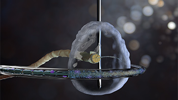 iovera°: The Use of Cold Therapy to Reduce Knee Pain and Improve ...