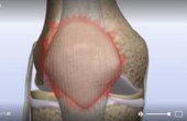 Patellofemoral Pain Treatment Chicago, IL | Patellar Instability ...