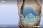 Meniscus Damage Treatment Chicago, IL | Torn Meniscus Repair Chicago, IL
